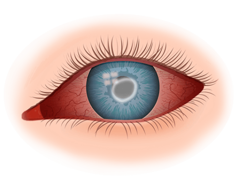 Dry Eye Treatment in Buffalo, NY | Buffalo Ophthalmology