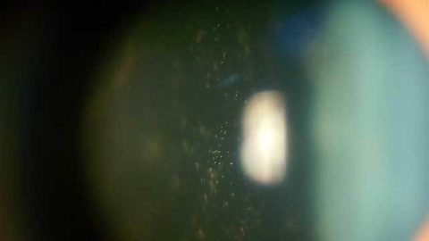 Uveitis Treatment Buffalo | Uveitis Specialist NY | Uveitis Eye Doctor